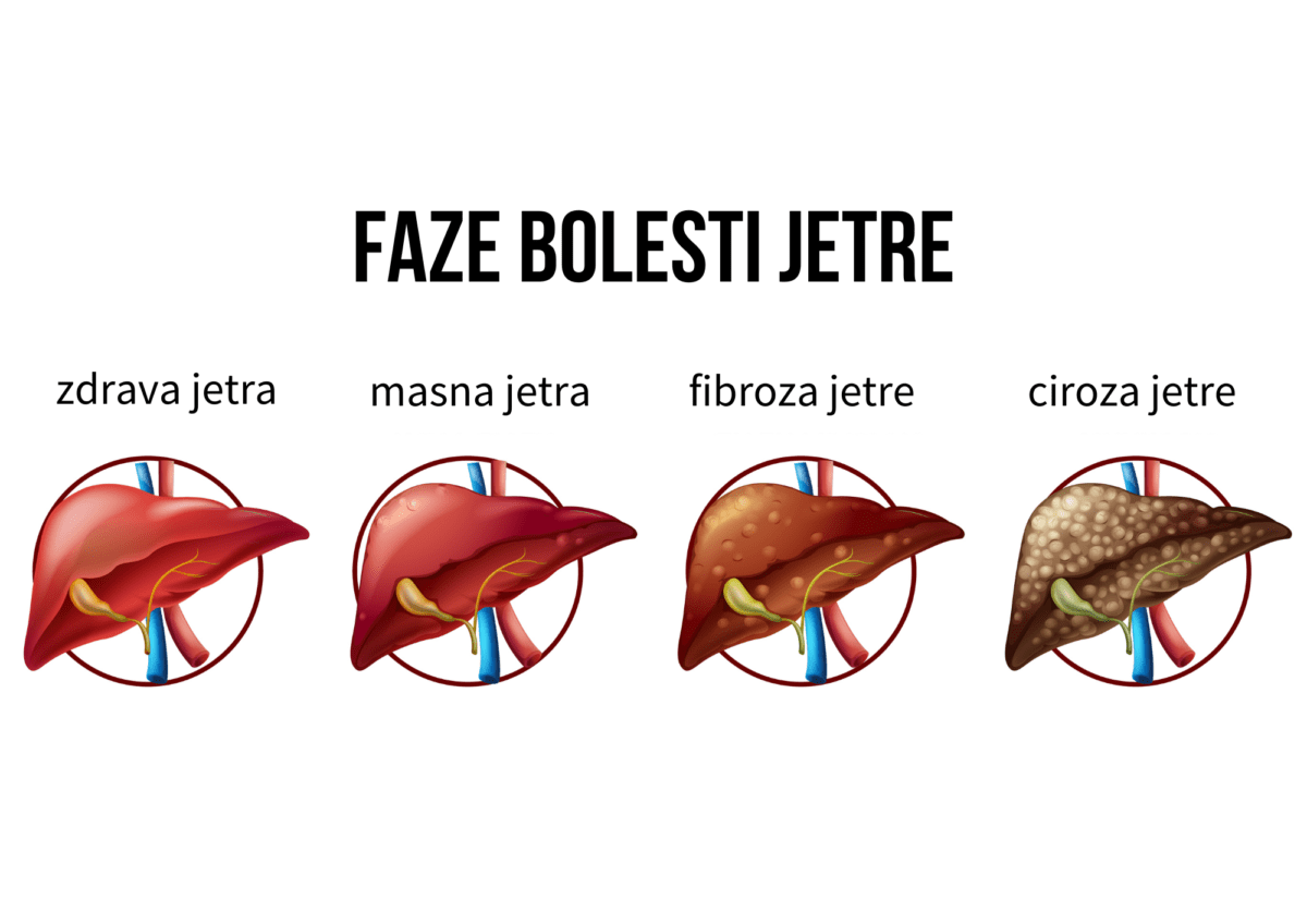 Saveti za prevenciju i lečenje masne jetre: ključ za zdravlje jetre i srca | Medico Cubano